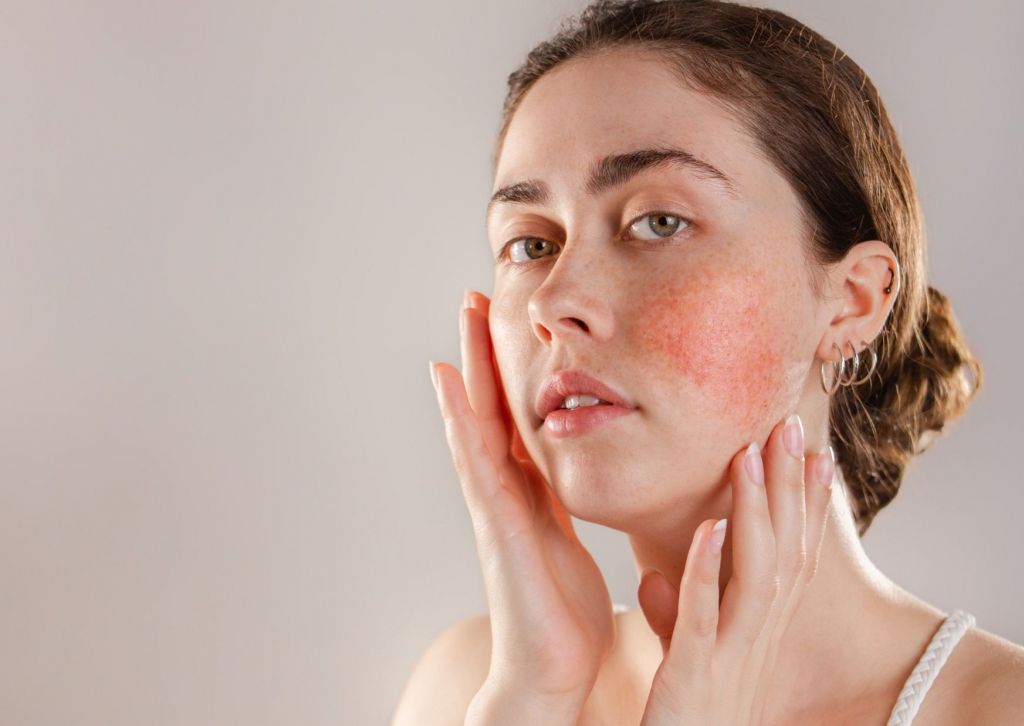 Comment traiter la rosacée ? | Blog bio Kazidomi